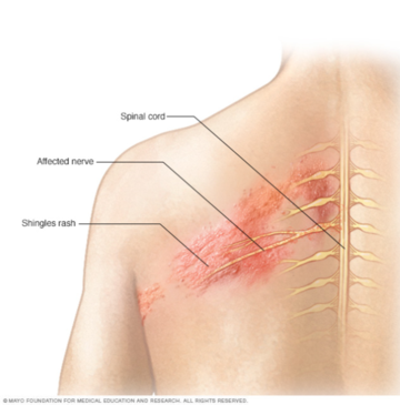 Shingles